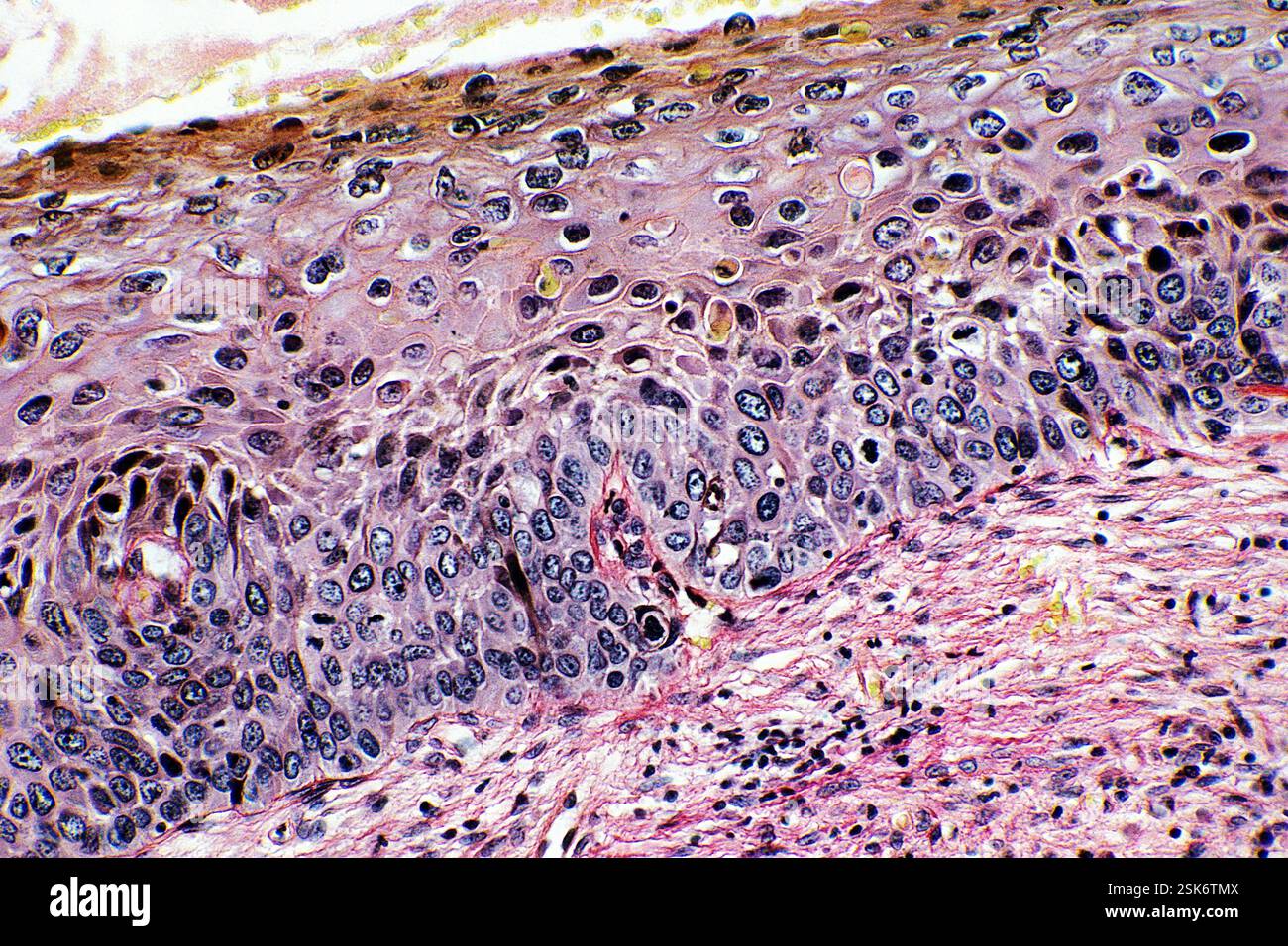 Mild cervical dysplasia. Light micrograph of a section through cervical ...