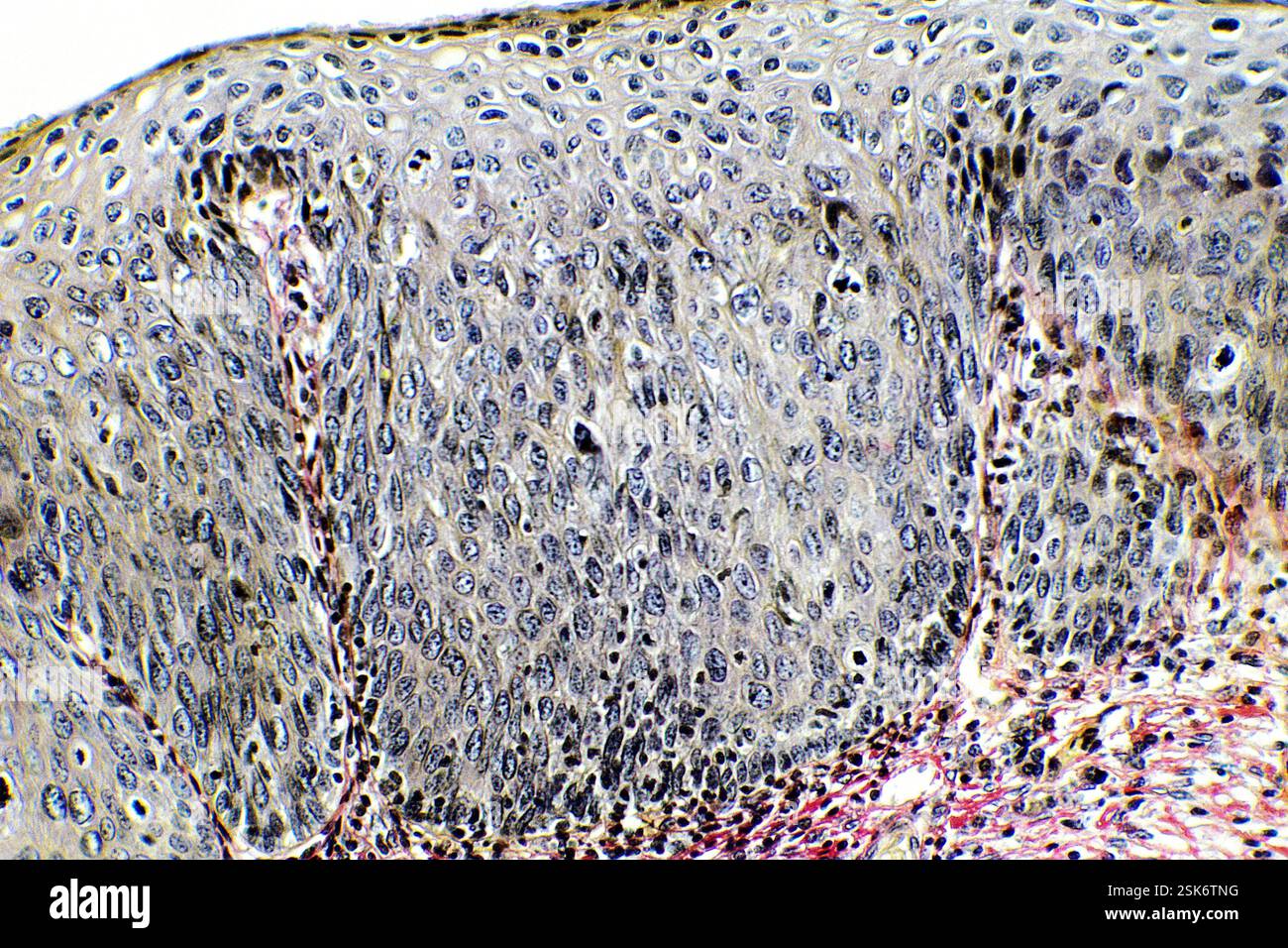 Severe cervical dysplasia. Light micrograph of a section through ...