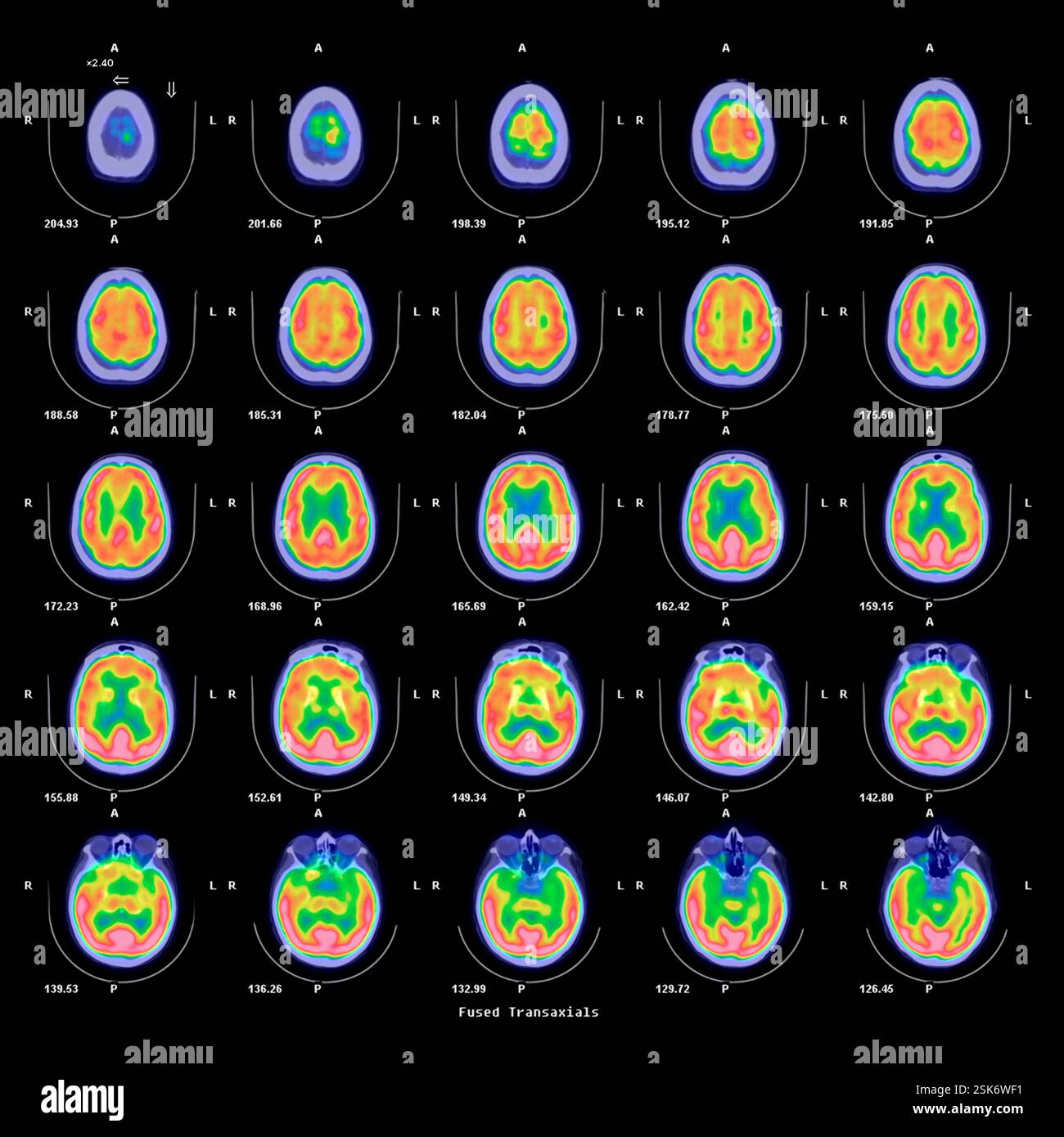Human brain, combined computed tomography (CT) and positron emission ...