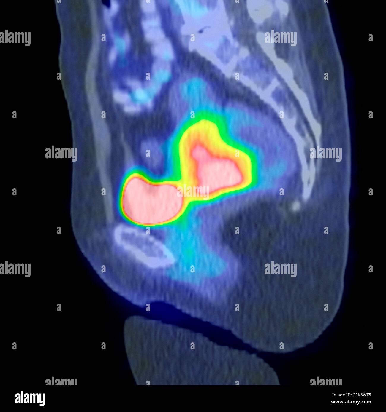 Cervical cancer. Combined profile computed tomography (CT) and positron ...