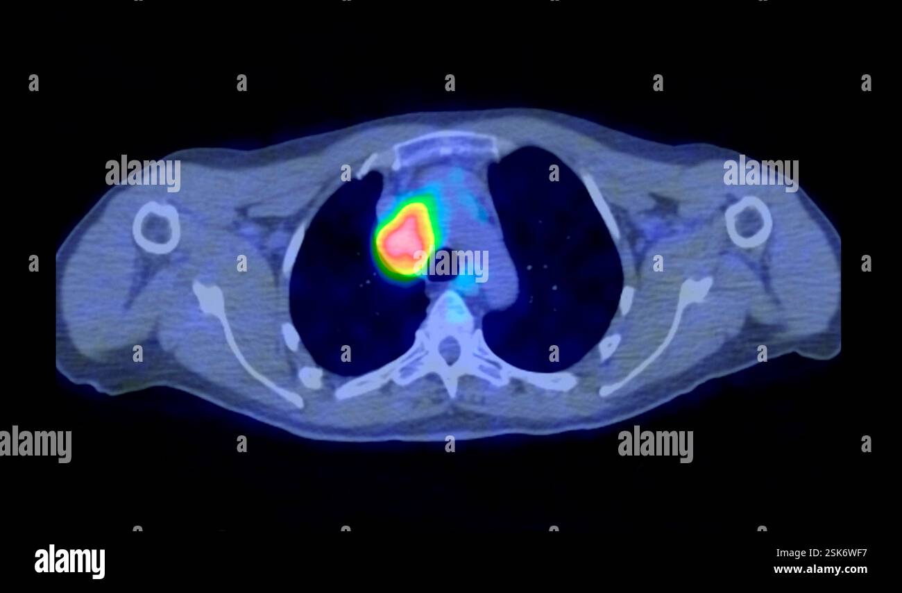 Lymph node cancer. Combined cross-sectional computed tomography (CT ...