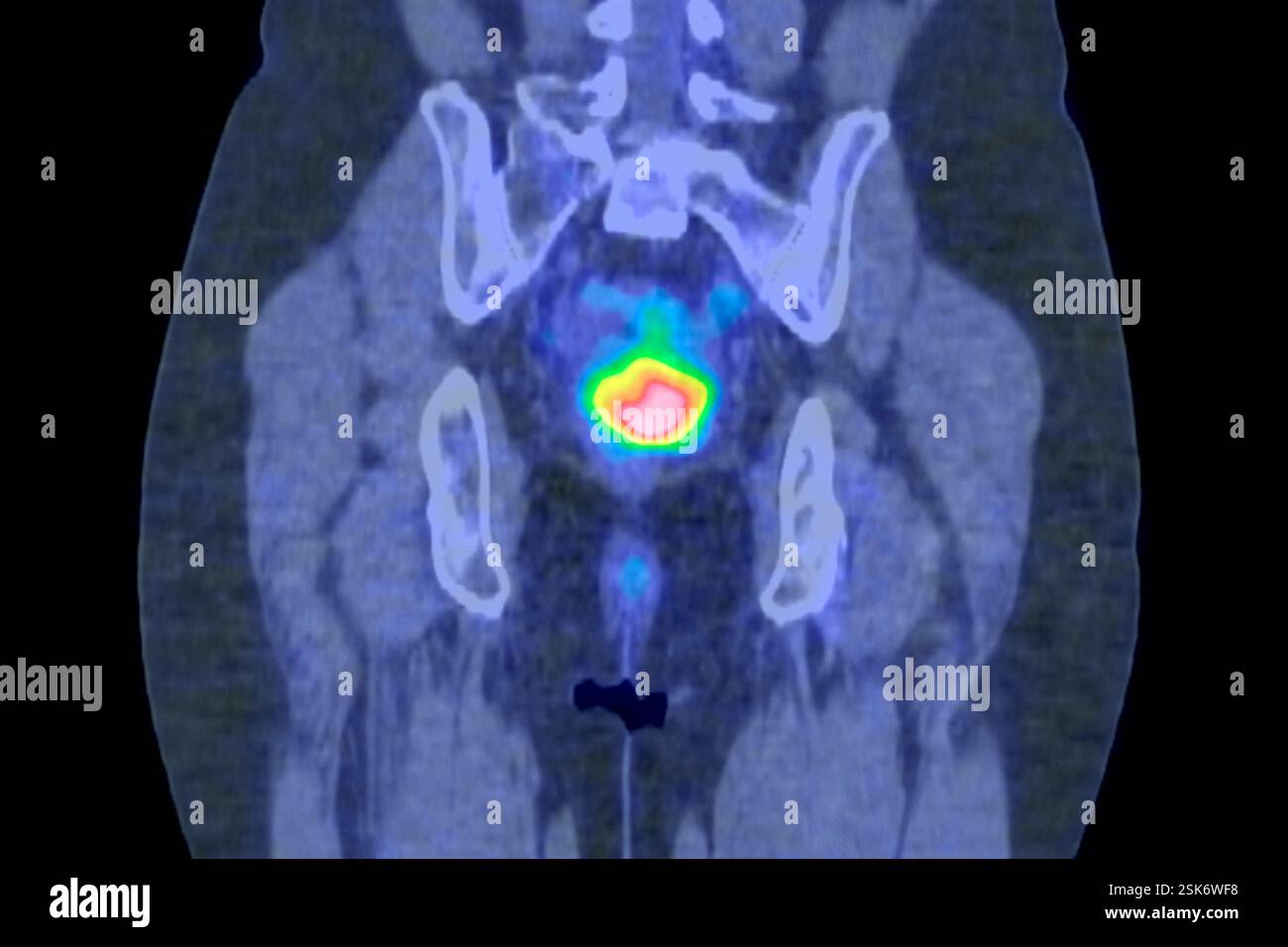 Cervical cancer. Combined frontal computed tomography (CT) and positron ...
