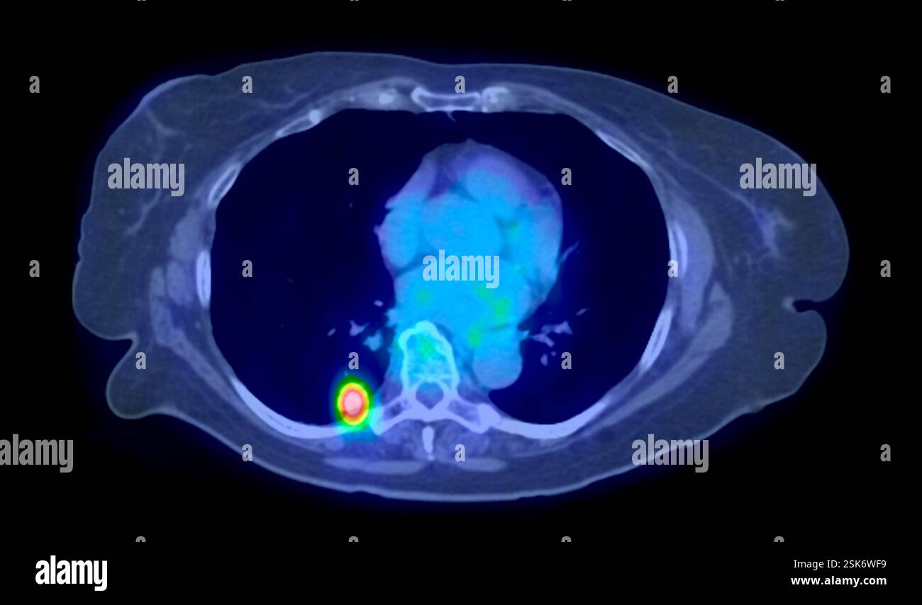 Lung cancer. Combined cross-sectional computed tomography (CT) and positron emission tomography ...