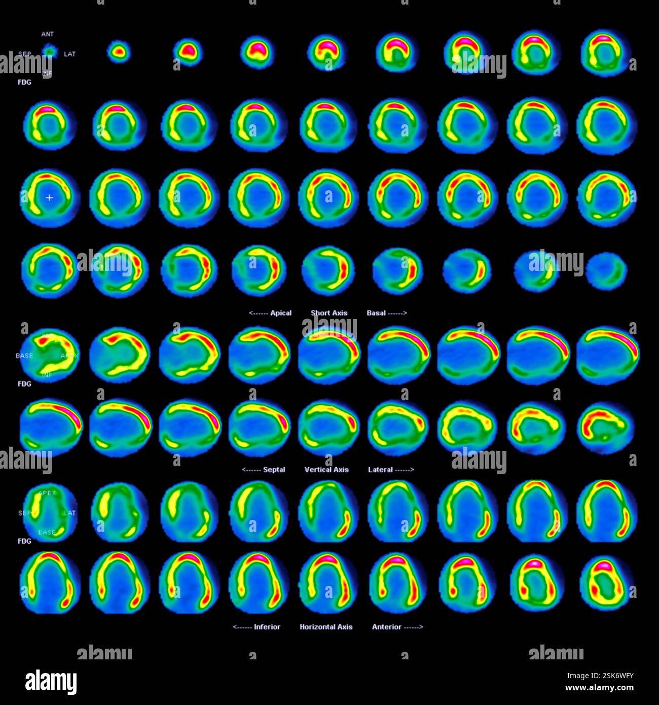 Enlarged heart. Three sequences of combined computed tomography (CT ...
