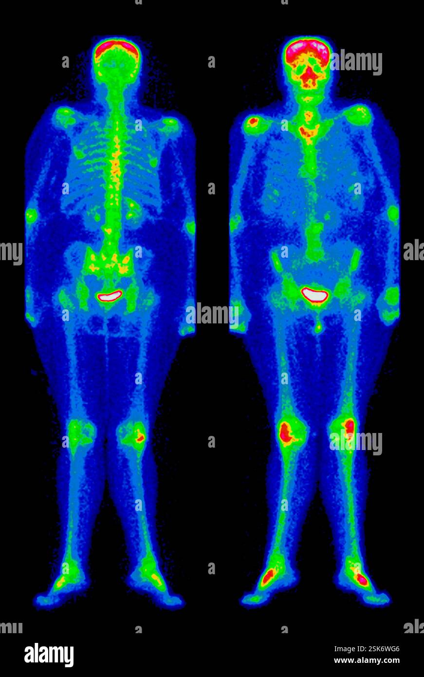Obesity, scintigram. Whole body bone scan of an obese 62-year-old woman ...