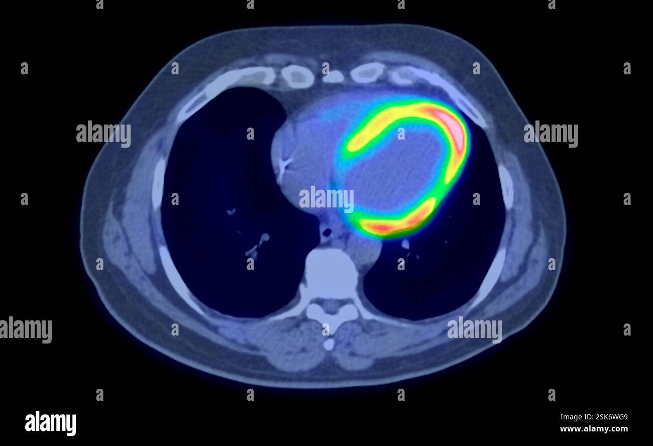 Enlarged heart. Combined cross-sectional computed tomography (CT) and ...