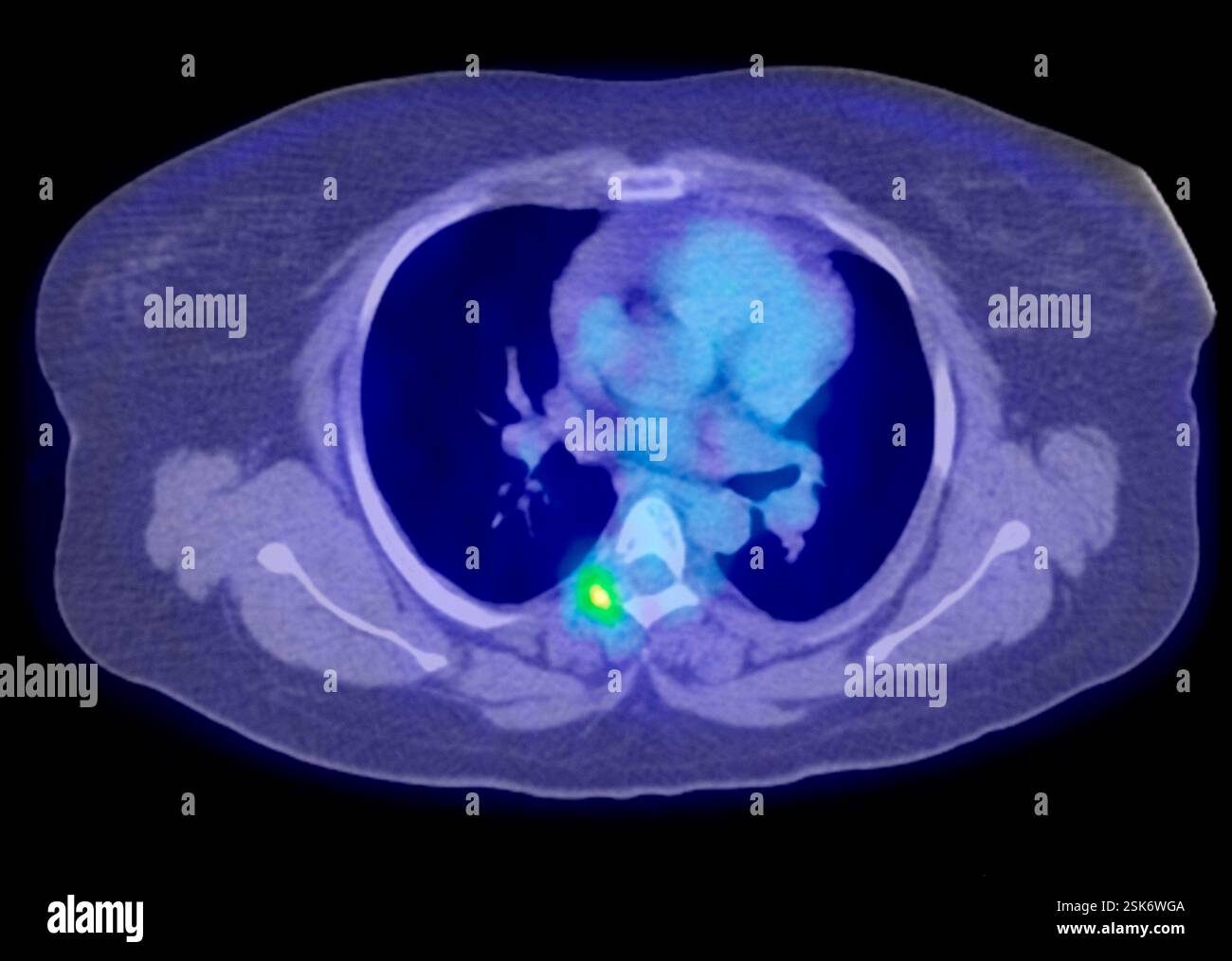 Coloured Computed Tomography (CT) scan in axial section of the chest of ...