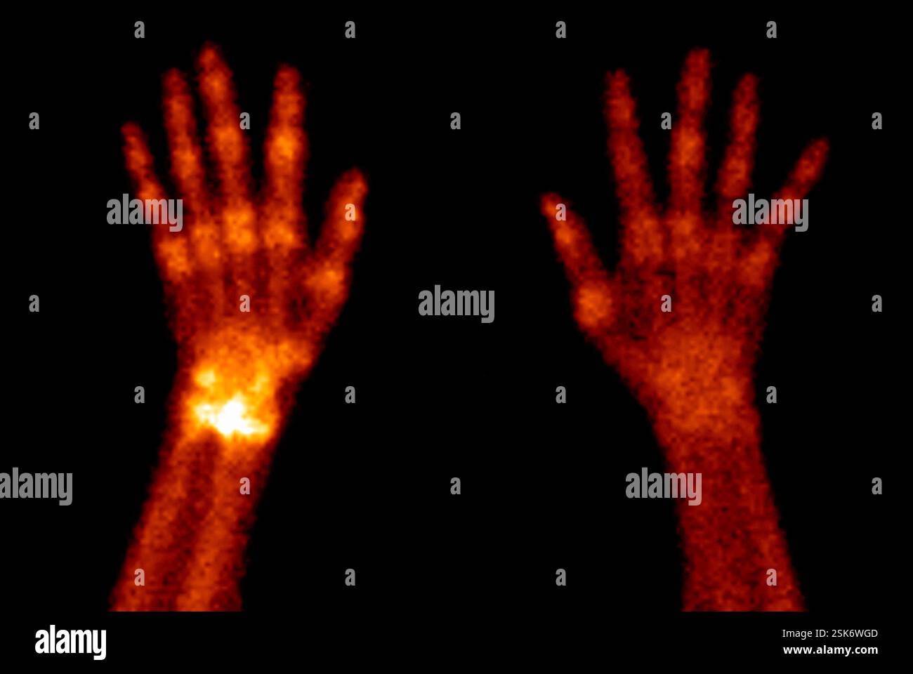 Algodystrophy of the hands, scintigram. Algodystrophy (reflex ...