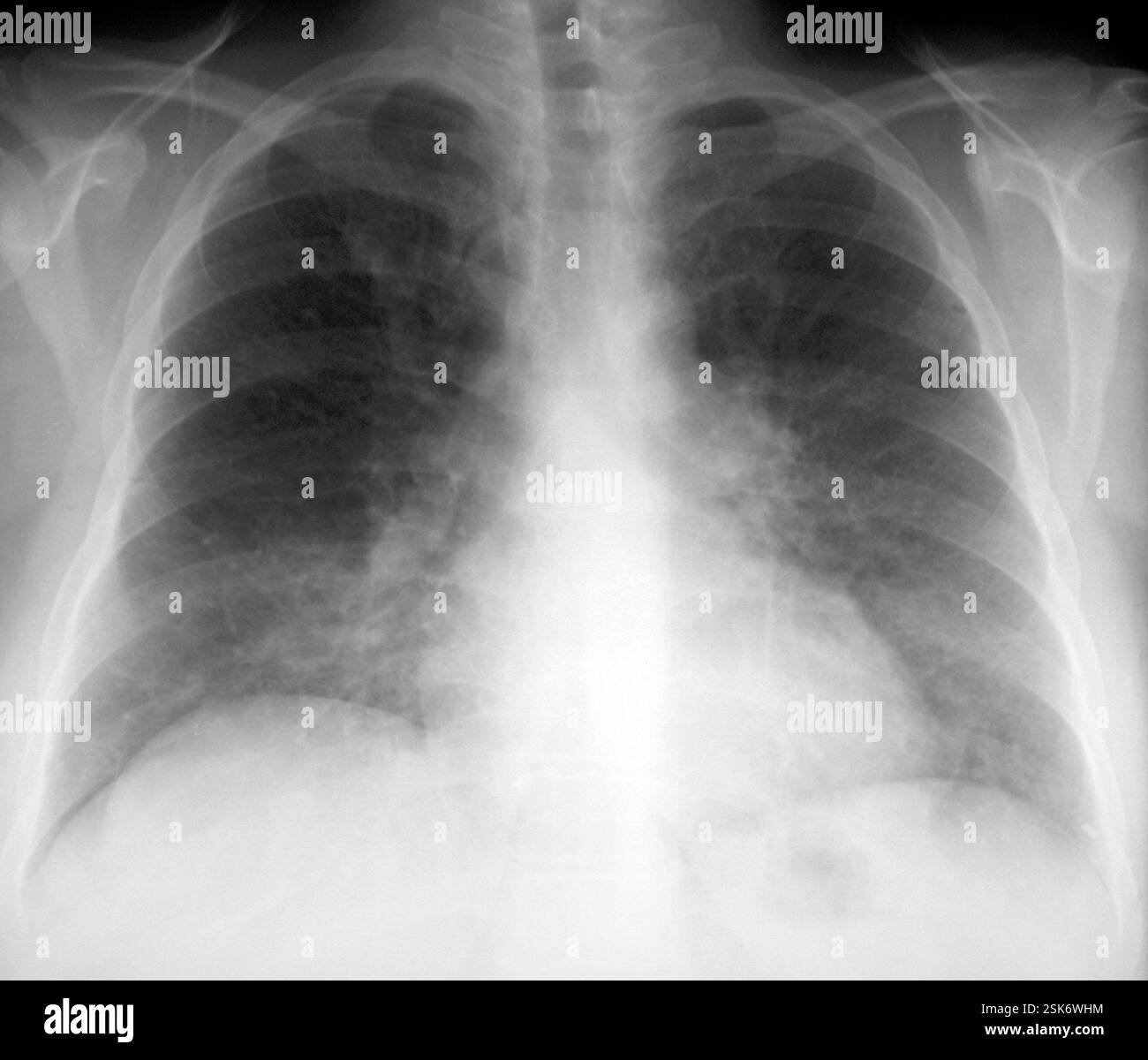 X-ray (front view) of the chest of a patient, showing desquamative ...