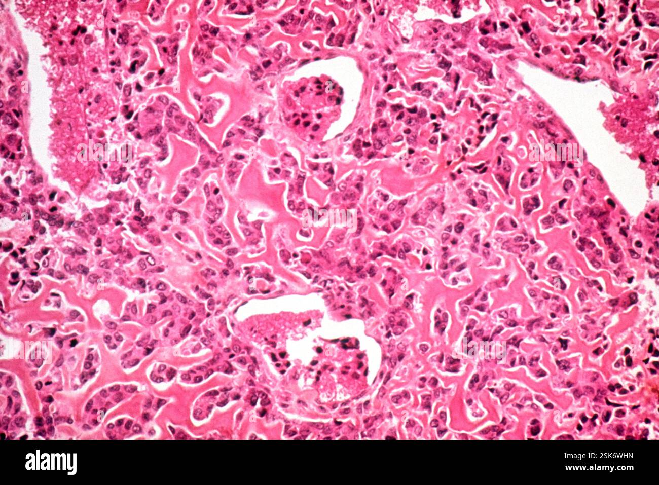 Light micrograph of a section through bone showing osteosarcoma cancer ...