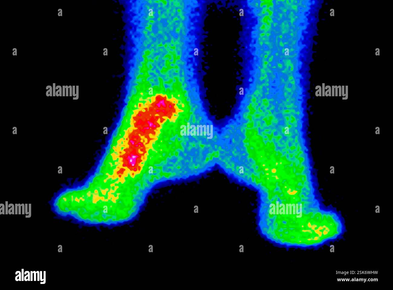 Algodystrophy of the feet, scintigram. Algodystrophy (reflex ...