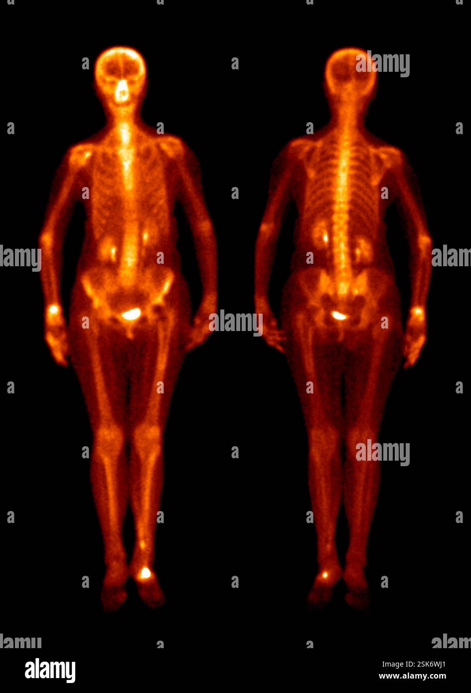 Bone scintigram (anterior and posterior view) of the whole body of an ...