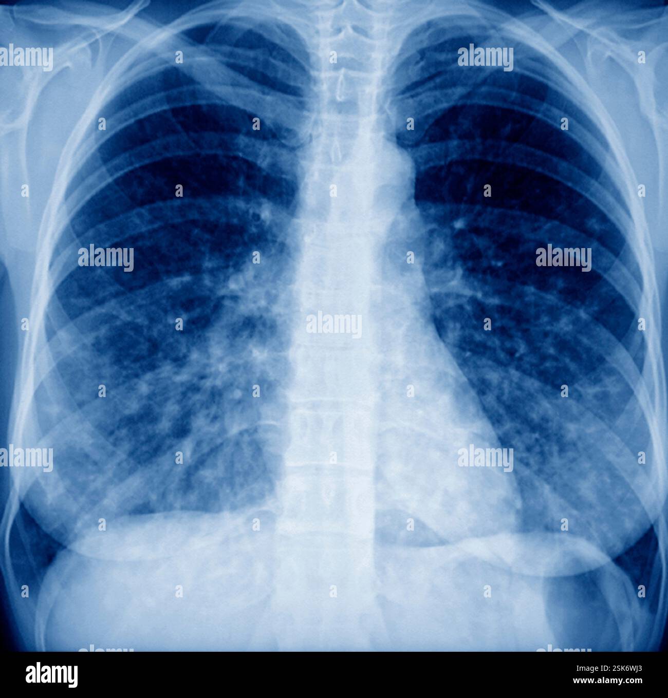 Coloured X-ray (front view) of the chest of an adult female patient ...