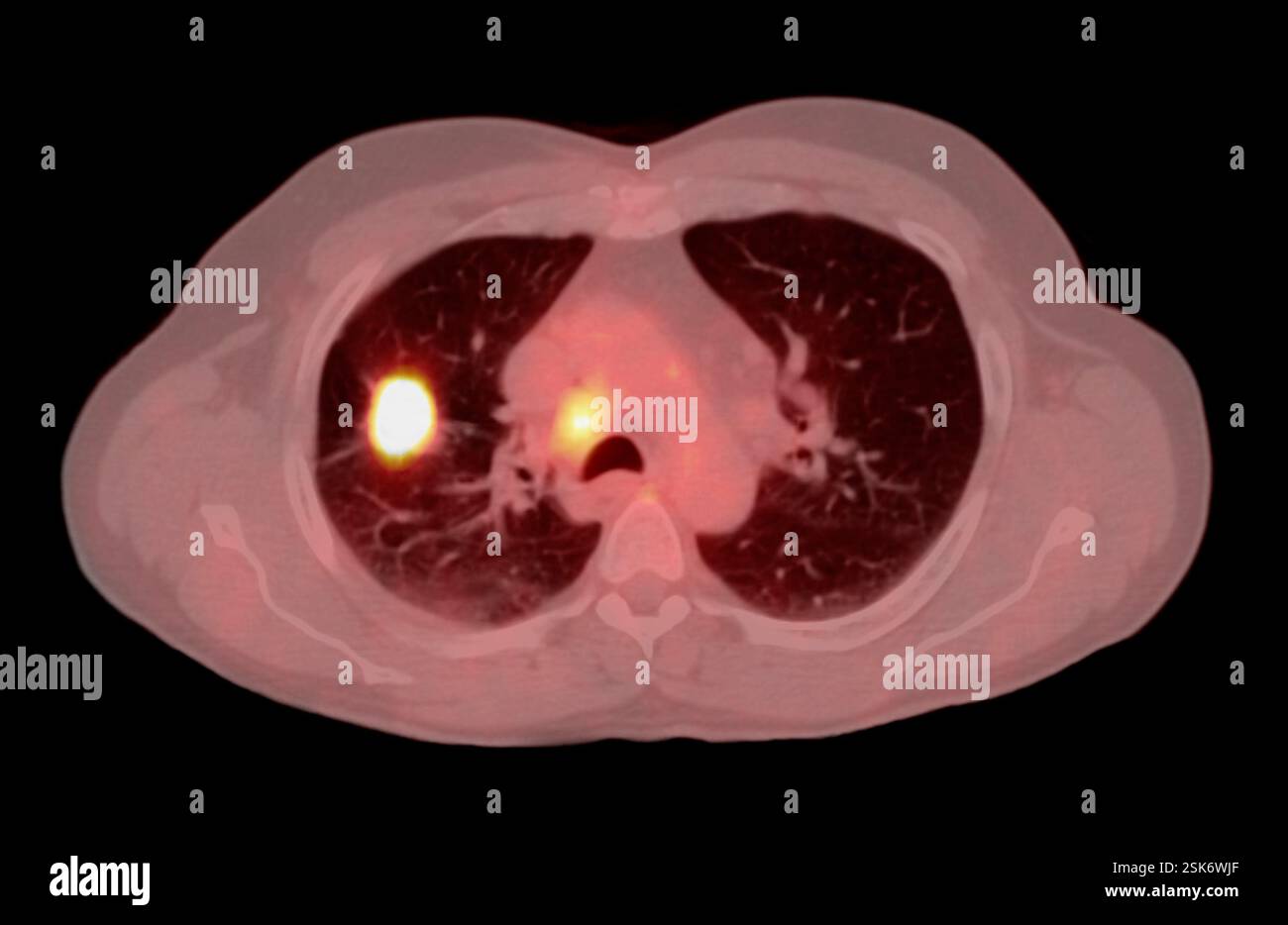 Coloured computed tomography (CT) scan in axial section through the chest of a patient showing ...