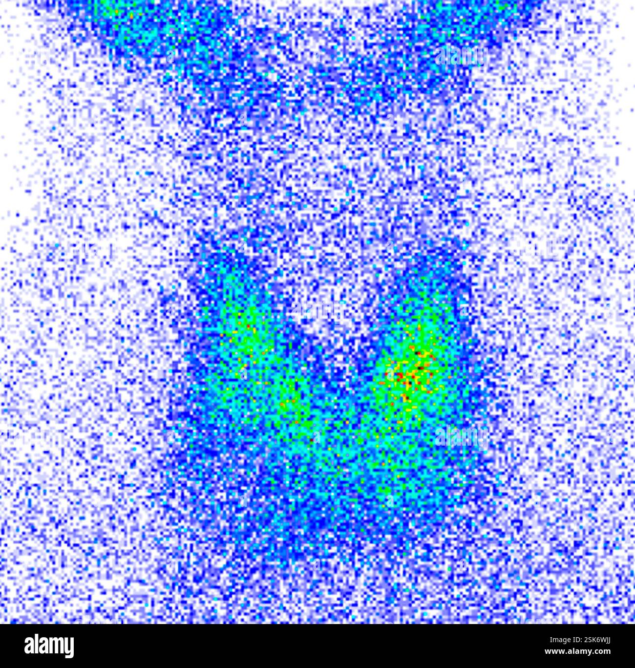 Scintigram (gamma scan) in anterior view of the thyroid gland of a 58 ...
