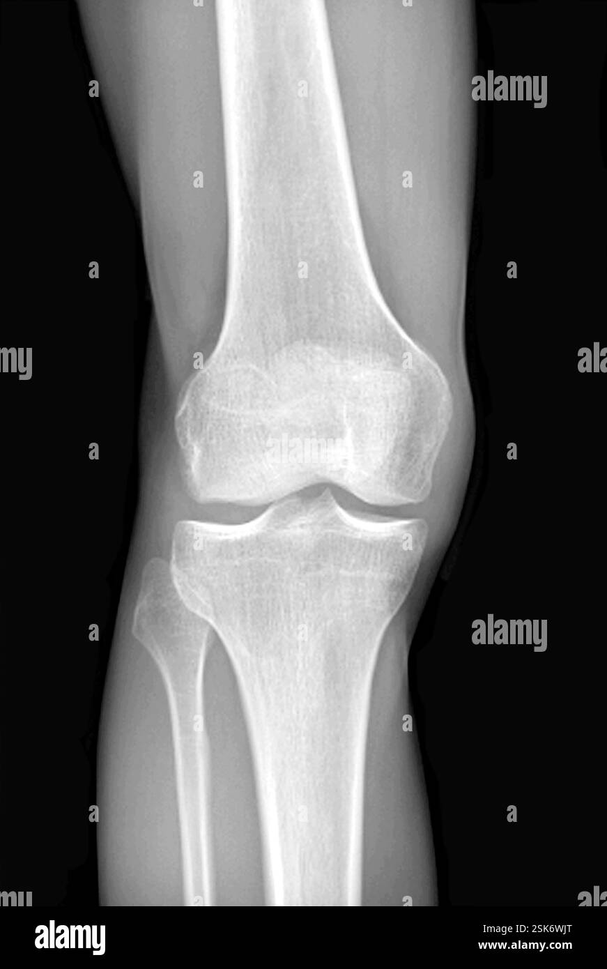 X-ray (front view) of the healthy knee joint in a 22 year old female ...