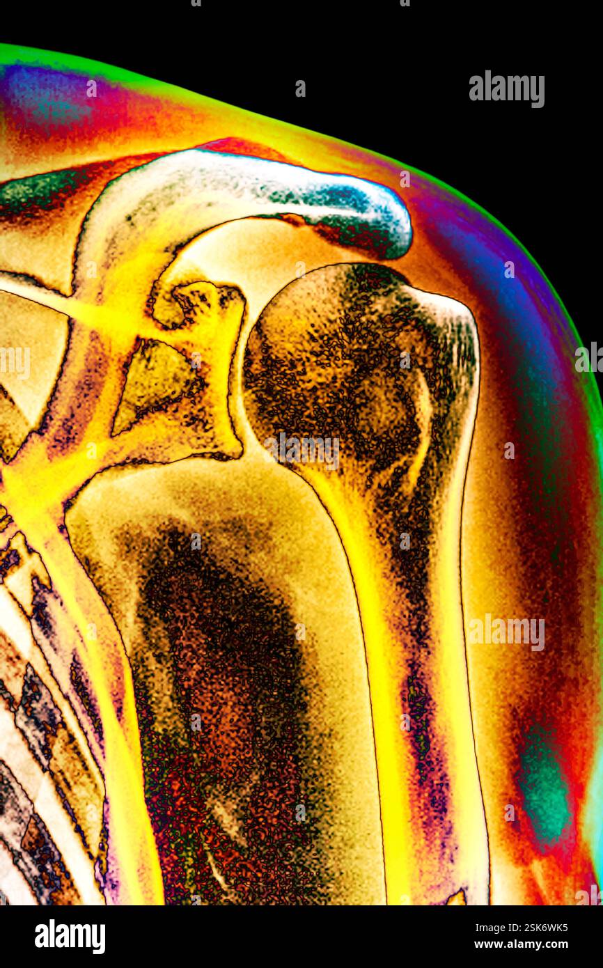 Coloured X-ray (front view) of the healthy shoulder joint and bones in a 25 year old male ...