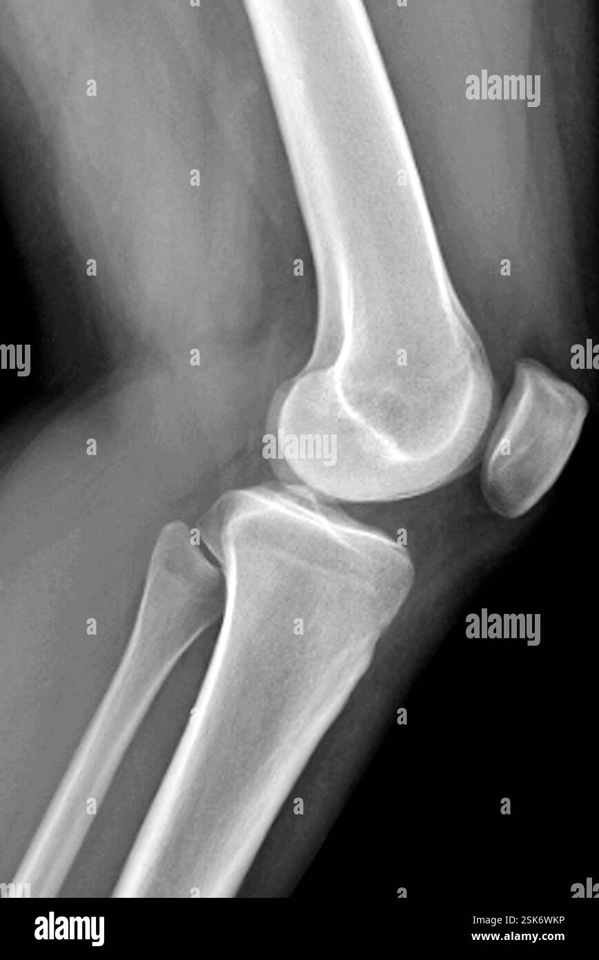 X-ray (side view) of the healthy knee joint in a 22 year old female ...