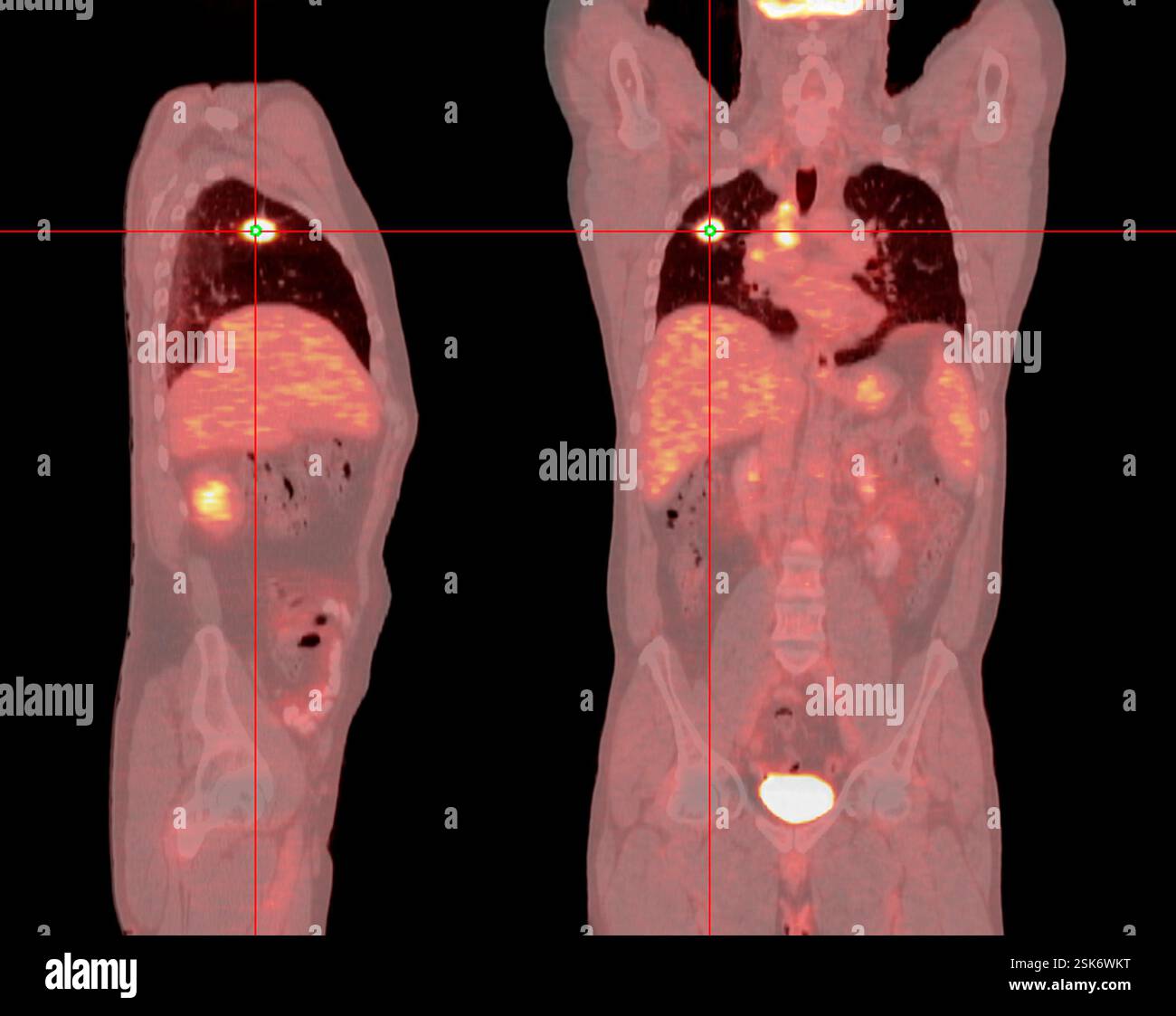 Coloured computed tomography (CT) scan in sagittal (side view) and coronal (front view) through ...