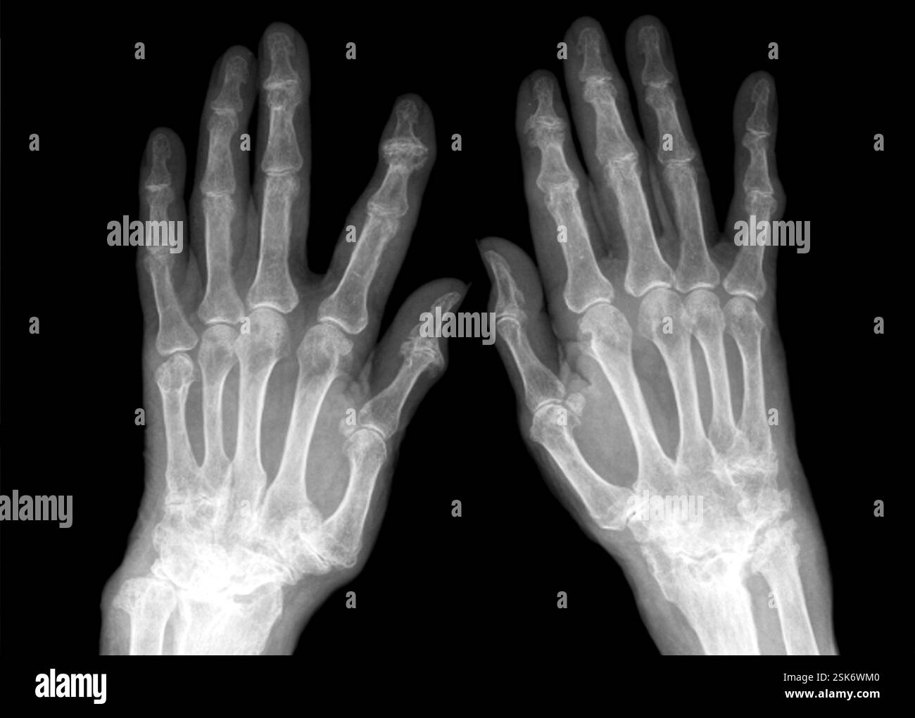 X-ray (top view) of the fingers of the hand in an 83 year old female ...