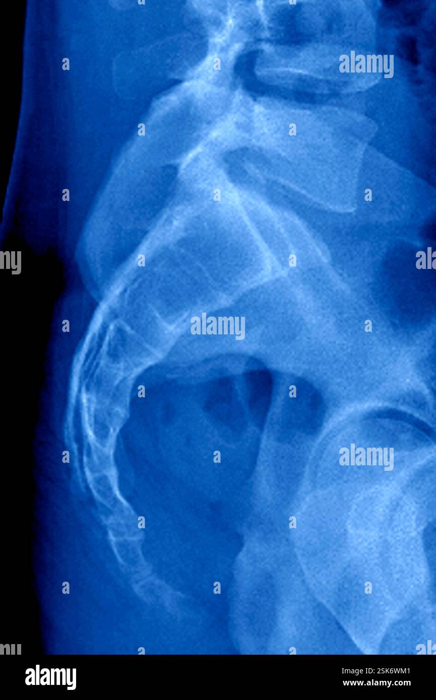 Coloured X-ray (side view) of the healthy sacrum and coccyx of the ...