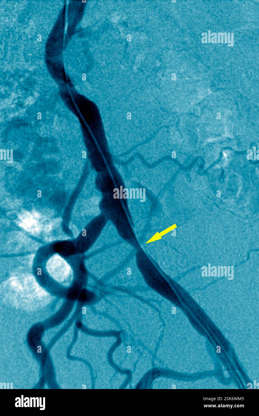 Coloured digital angiogram (X-ray) of the abdominal aorta and left ...