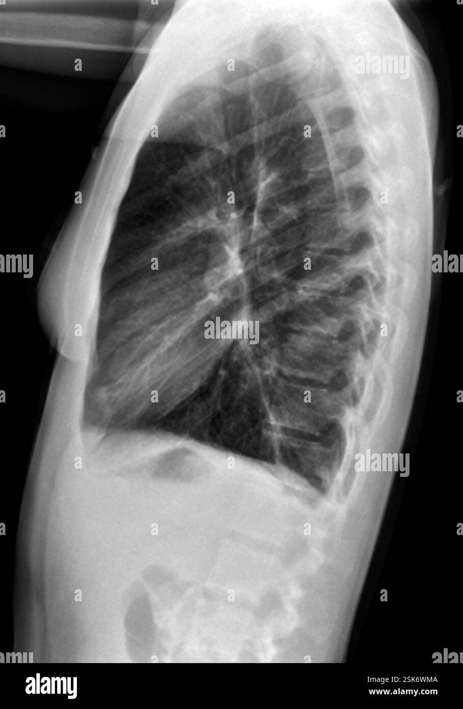 Chest X-ray (side view) of the healthy lungs in a 24 year old female ...