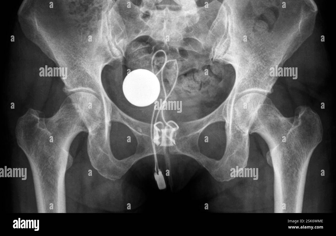 X-ray (front view) of the pelvis in a 55 year old female patient ...