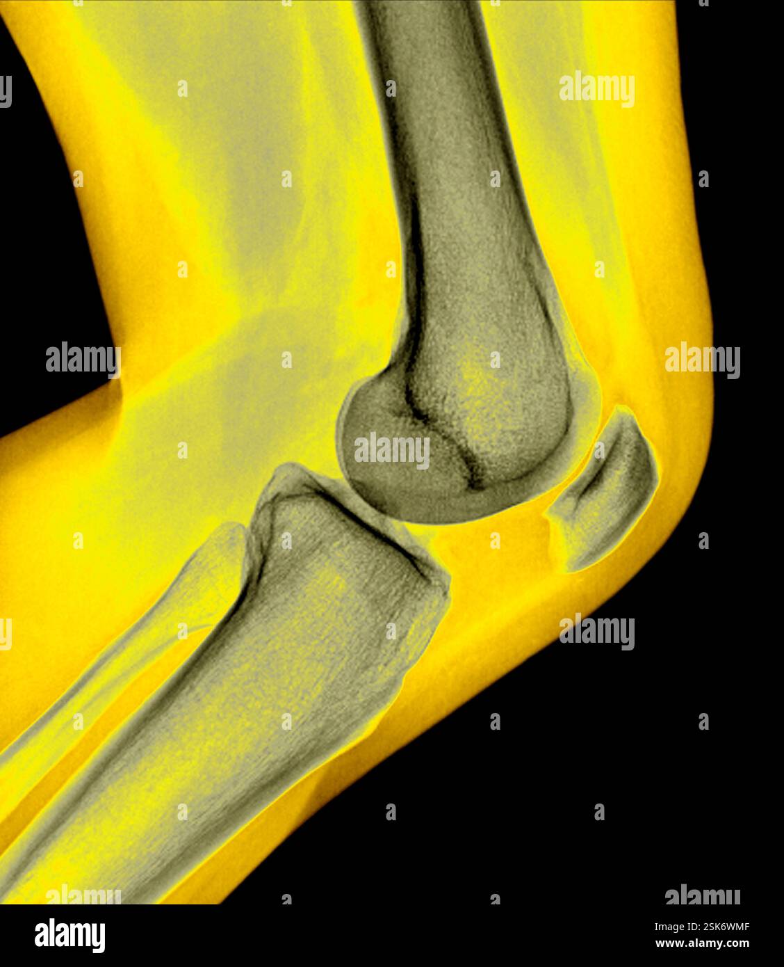 Coloured X-ray (side view) of the healthy knee joint in a 49 year old ...