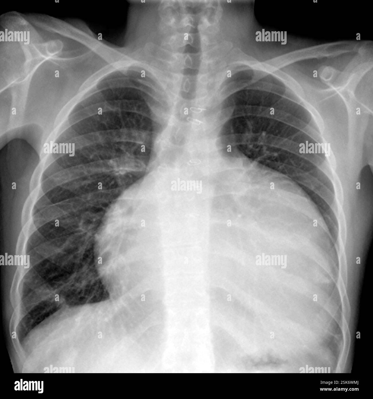X-ray (front view) of the chest of a 19 year old female patient after a ...