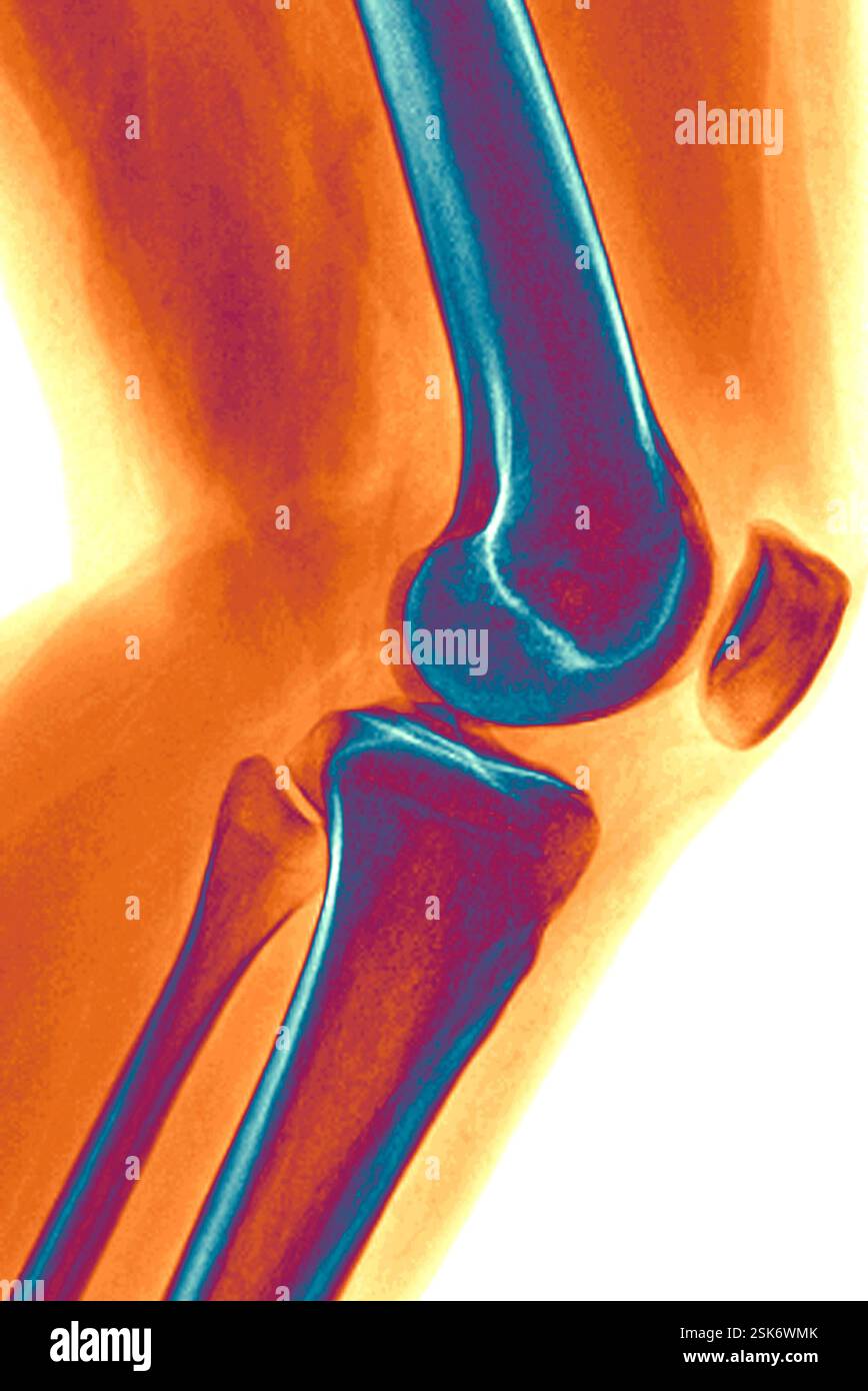 Coloured X-ray (side view) of the healthy knee joint in a 22 year old ...
