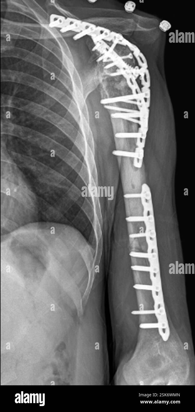 X-ray (front view) of a fractured (broken) shoulder and multiple ...