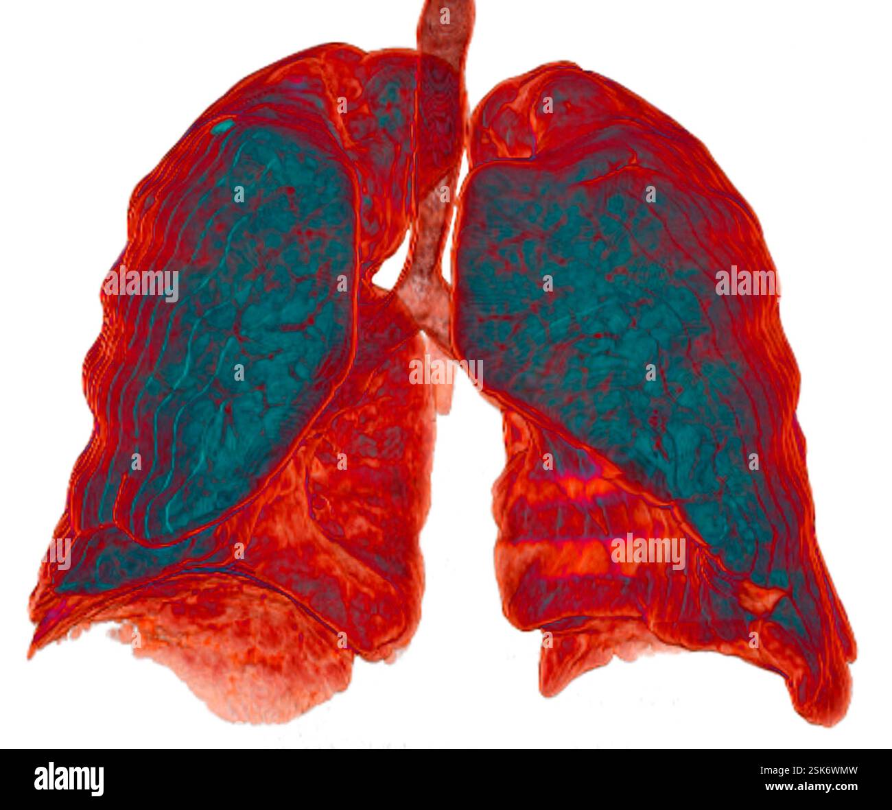 Coloured three-dimensional (3D) Computed Tomography (CT) scan in front view of a healthy trachea ...