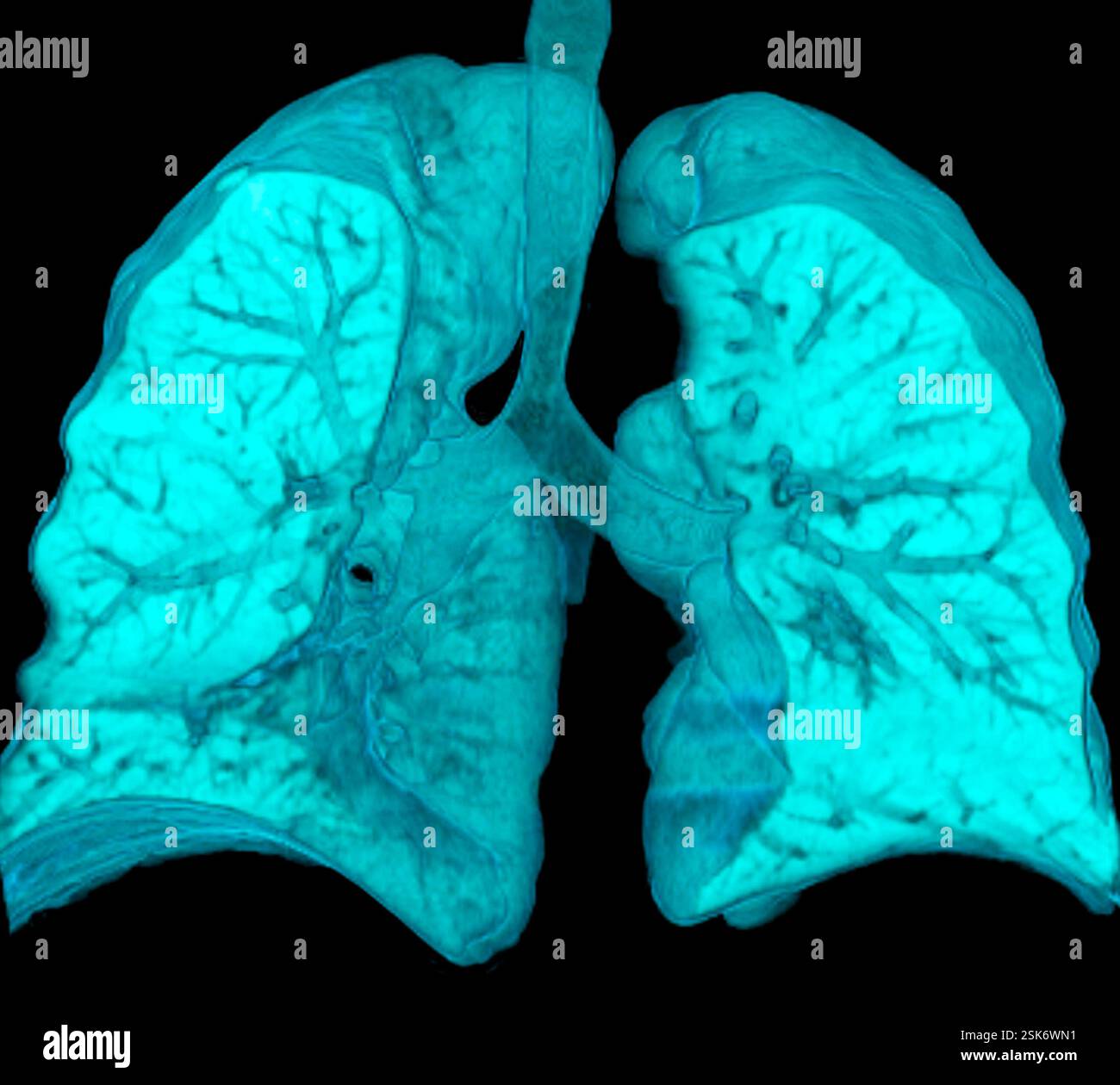 Coloured three-dimensional (3D) Computed Tomography (CT) scan in front view of a healthy trachea ...