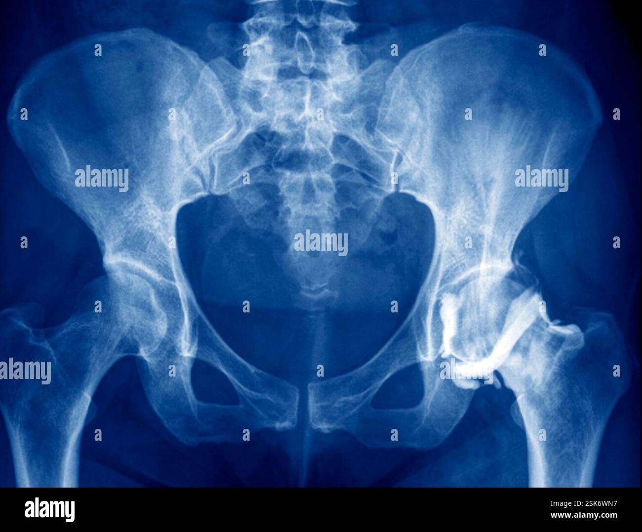 Coloured X-ray arthrogram (front view) of a healthy hip joint (at right ...