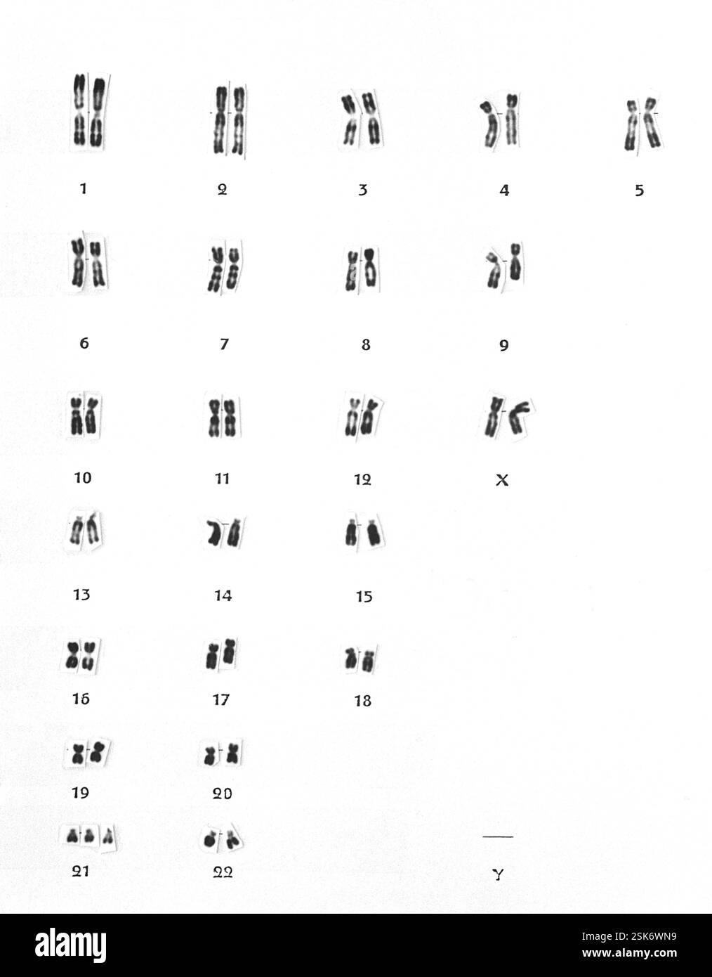 Female Down's syndrome karyotype. The complete set of chromosomes of an ...