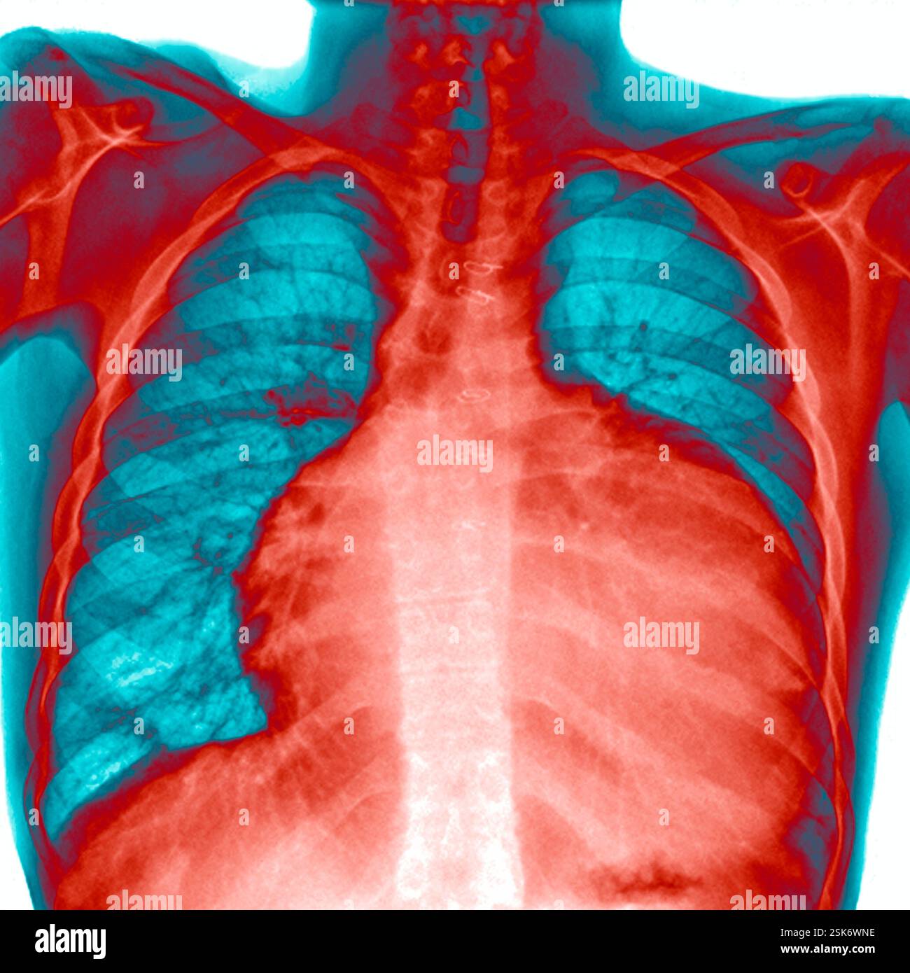 Coloured X-ray (front view) of the chest of a 19 year old female ...