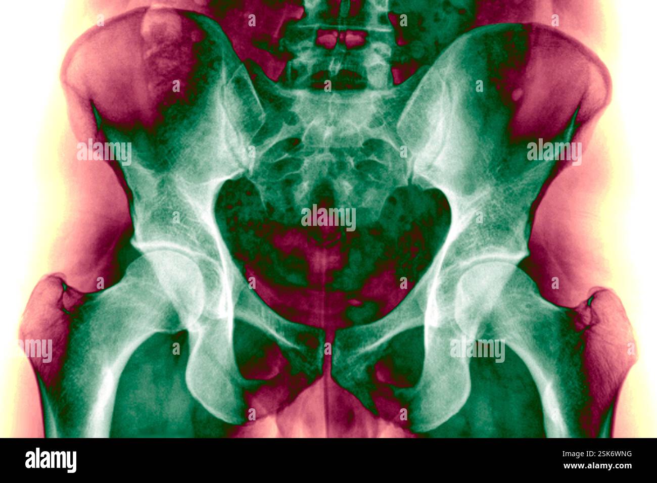 Coloured X-ray (front view) of the healthy bones of the pelvis in a 34 ...