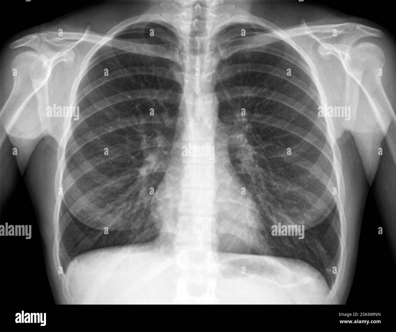 Chest X-ray (front view) of the healthy lungs in a 24 year old female ...