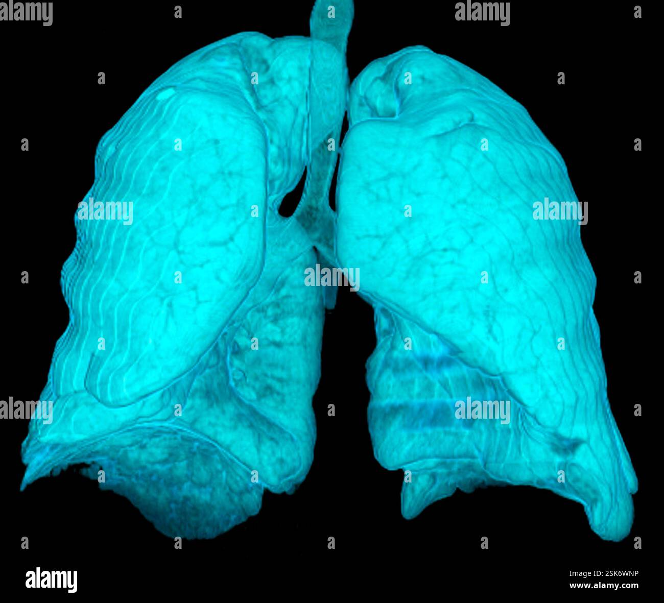Coloured three-dimensional (3D) Computed Tomography (CT) scan in front ...