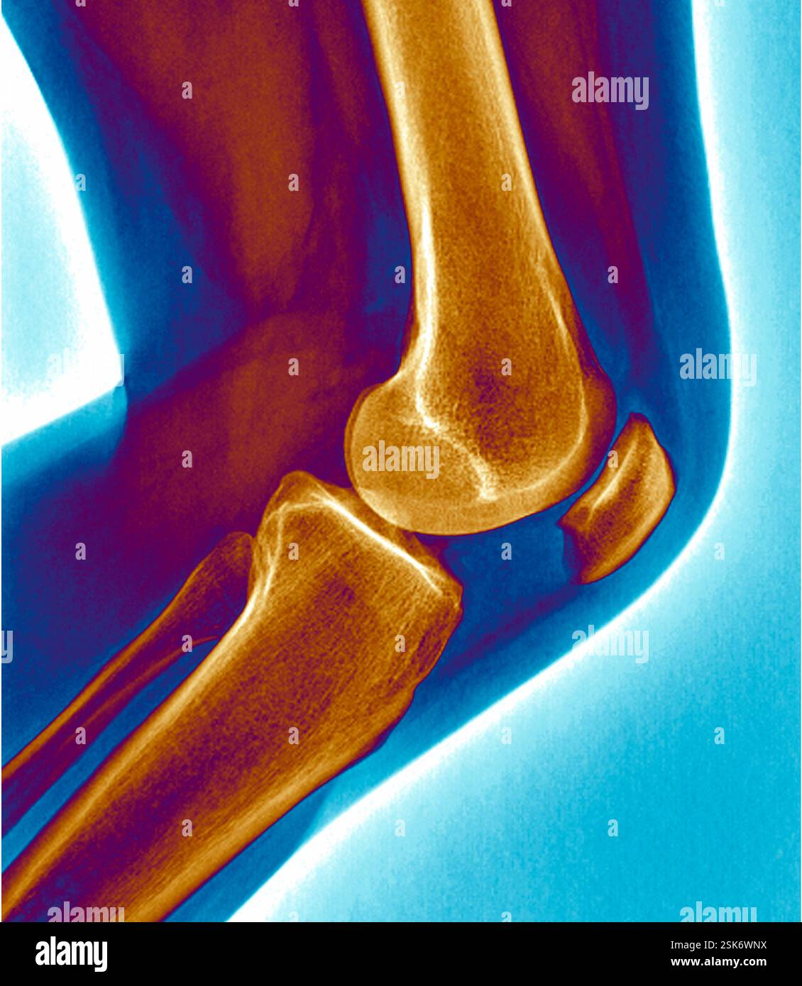 Coloured X-ray (side view) of the healthy knee joint in a 49 year old ...