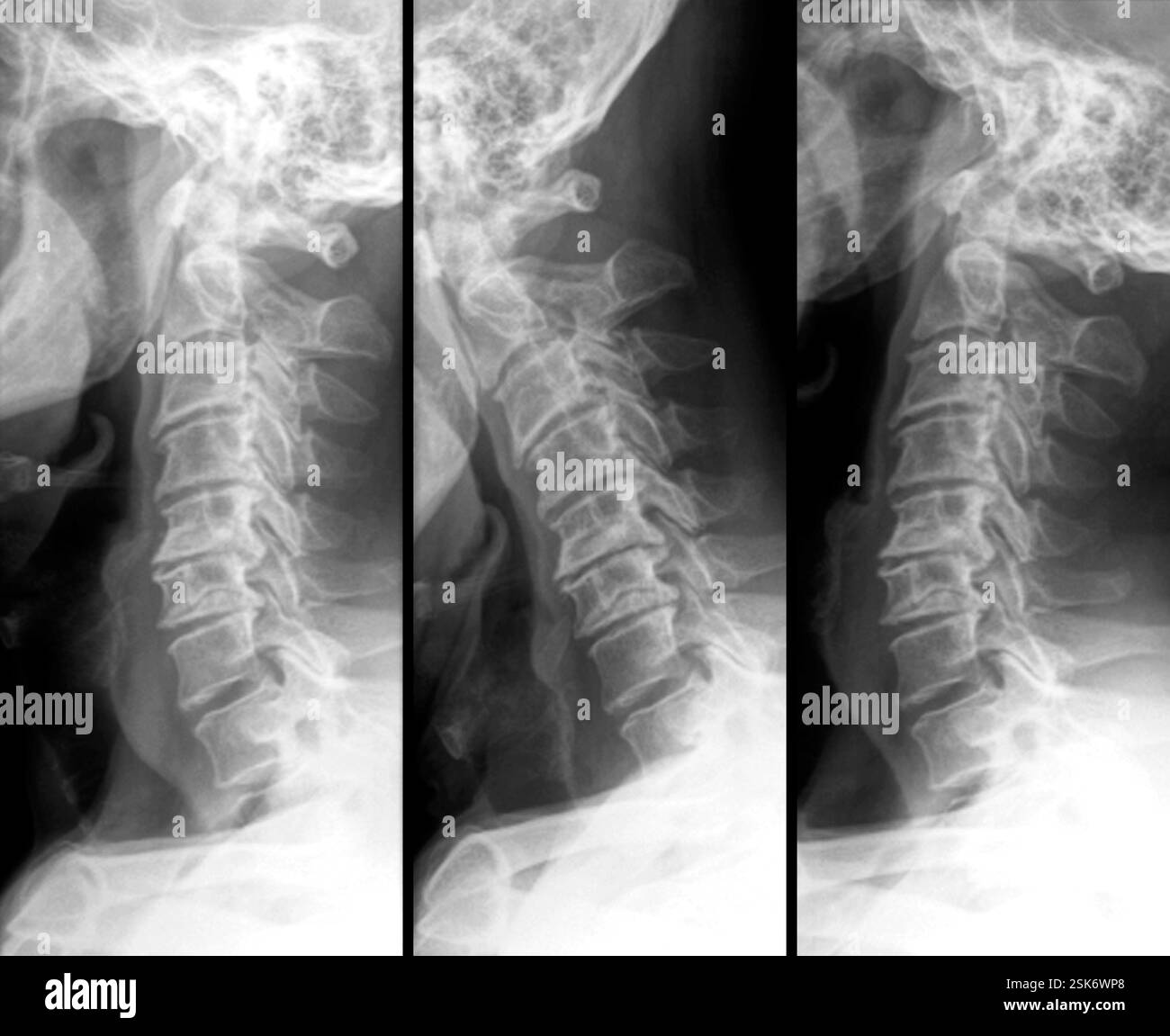 X-ray (side view, flexion and extension) of the cervical vertebrae of ...