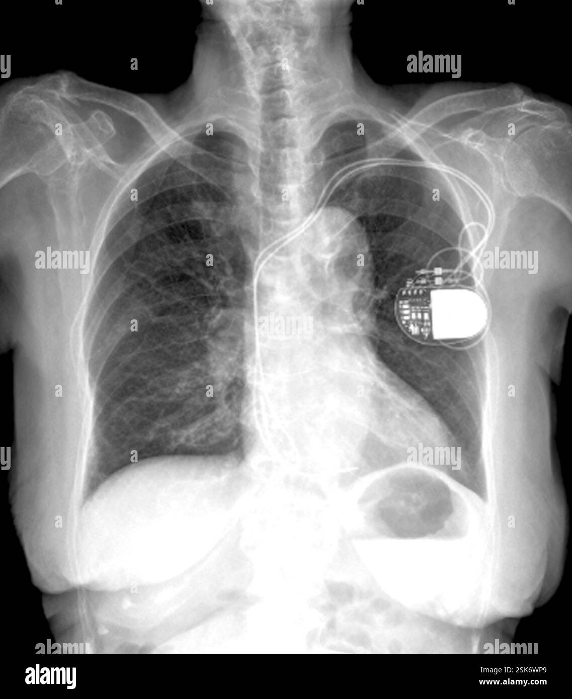 X-ray (front view) of the chest in an 84 year old male patient showing ...