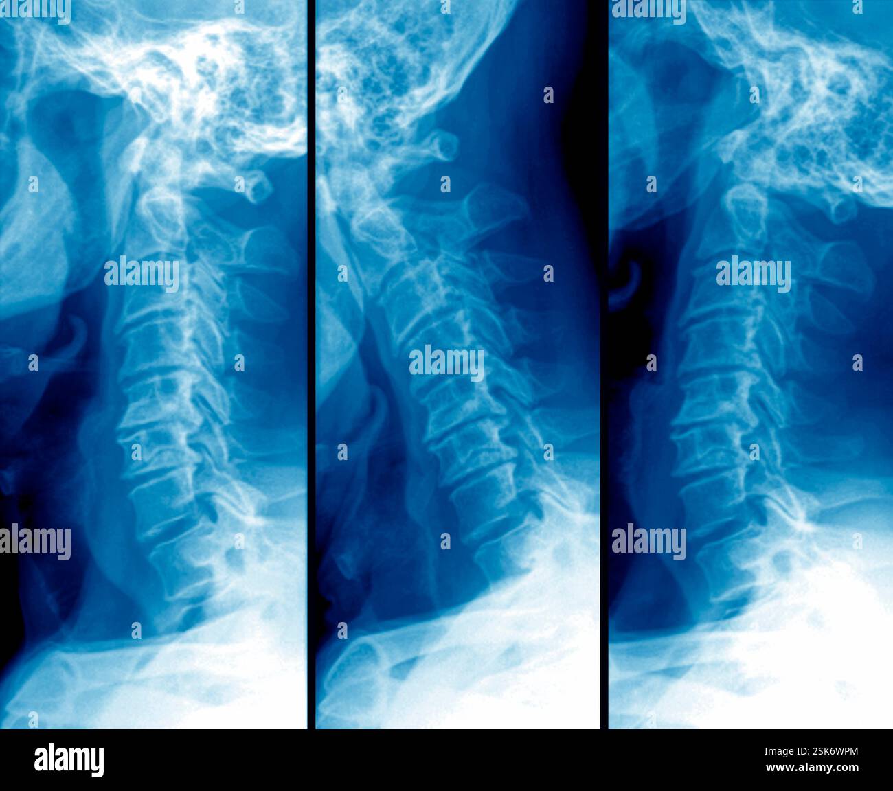 Coloured X-ray (side view, flexion and extension) of the cervical ...