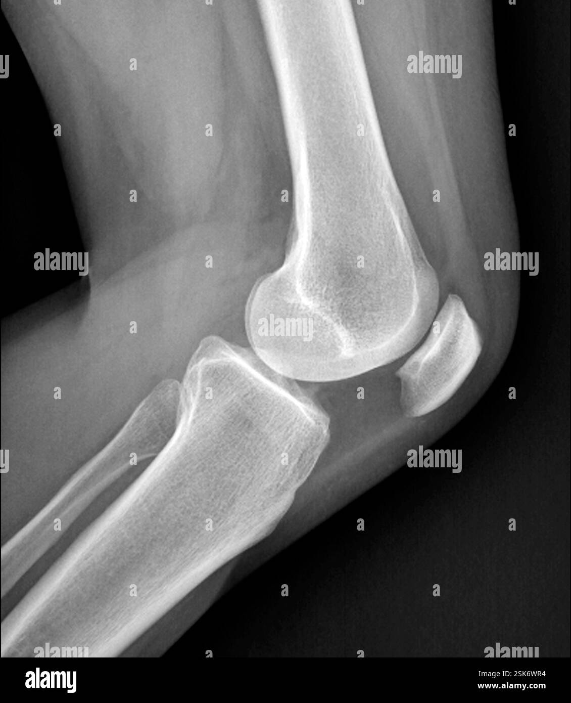 X-ray (side view) of the healthy knee joint in a 49 year old female ...