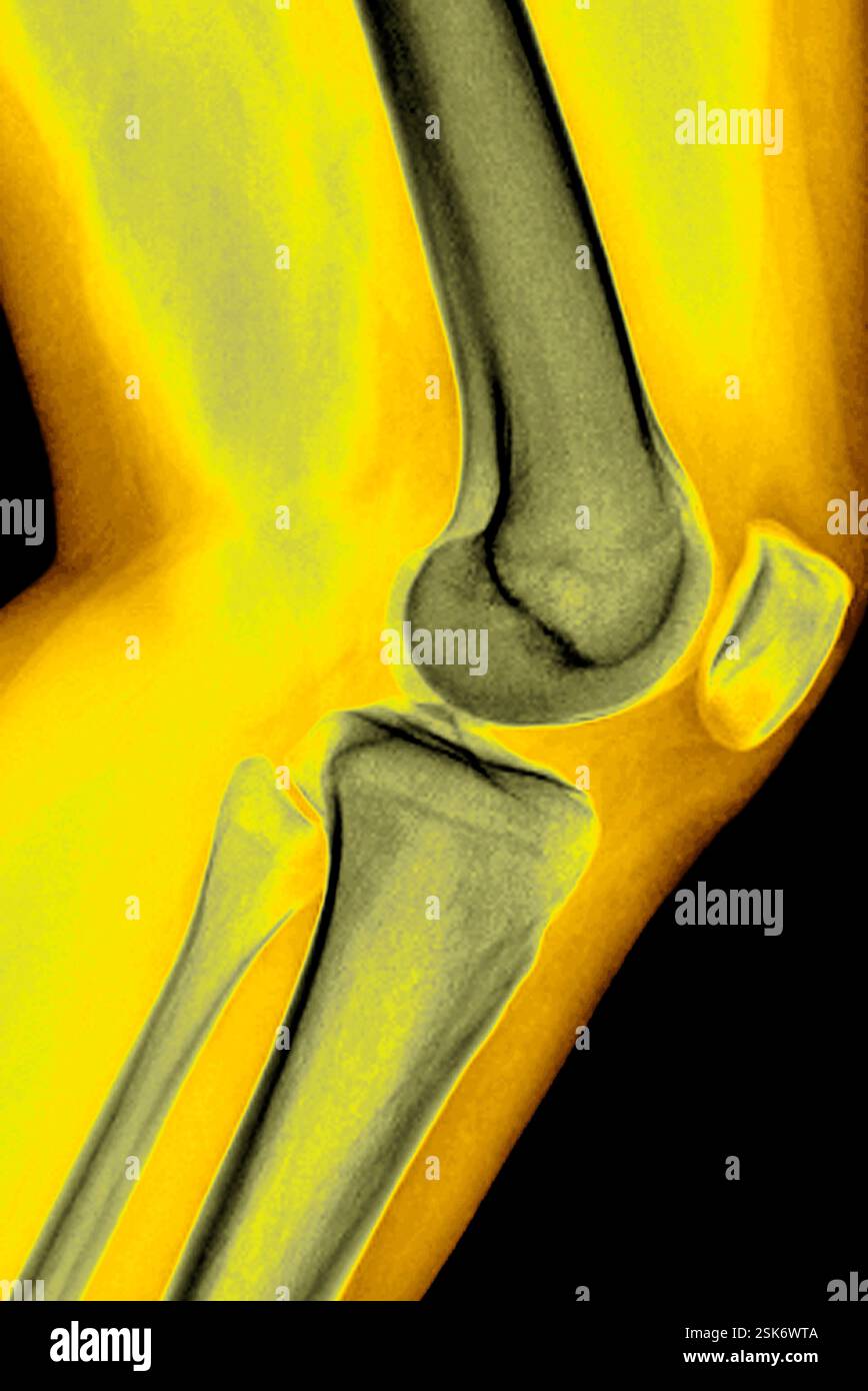 Coloured X-ray (side view) of the healthy knee joint in a 22 year old ...
