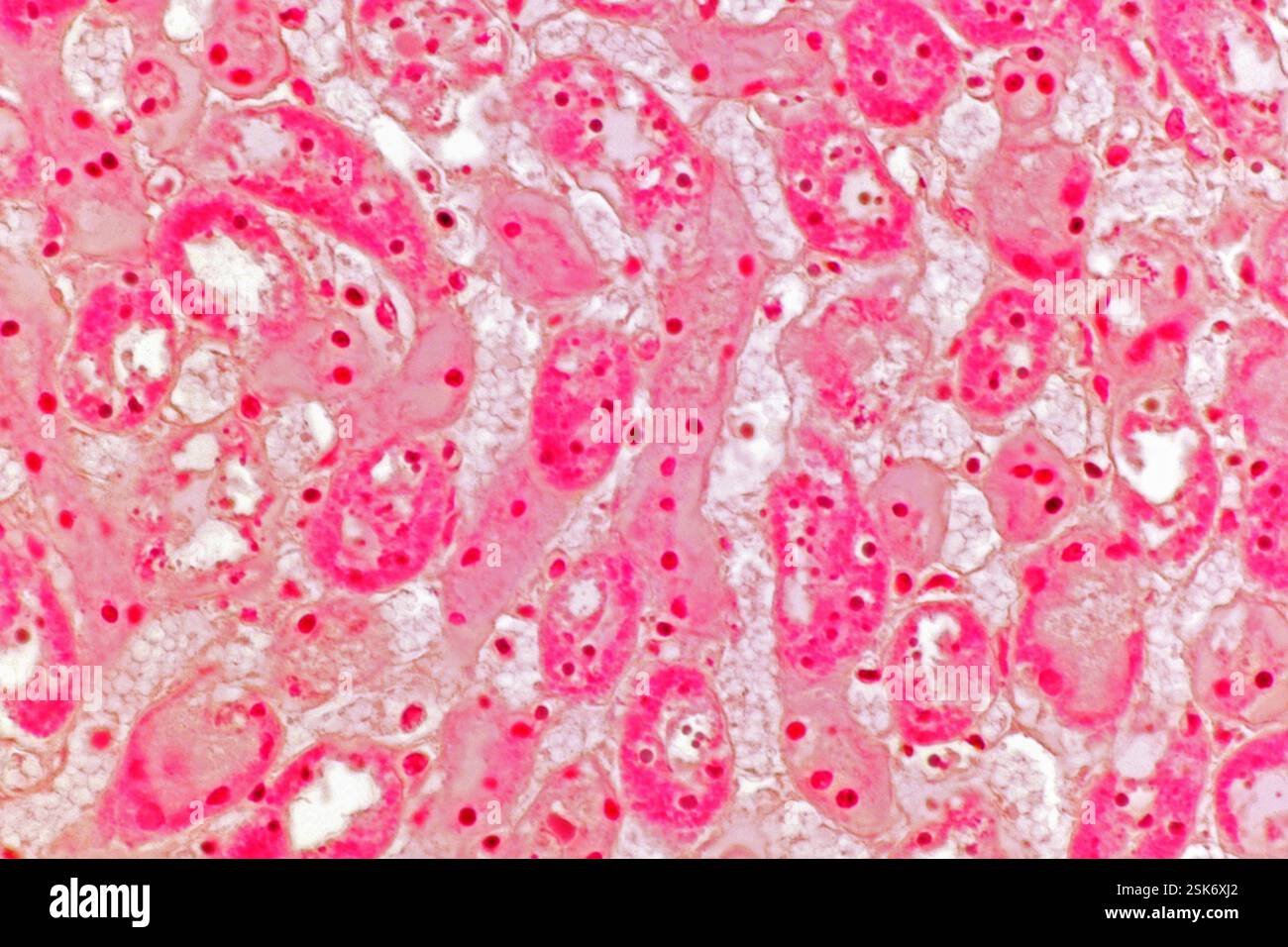 Rejected transplant kidney. Light micrograph of a section through a ...