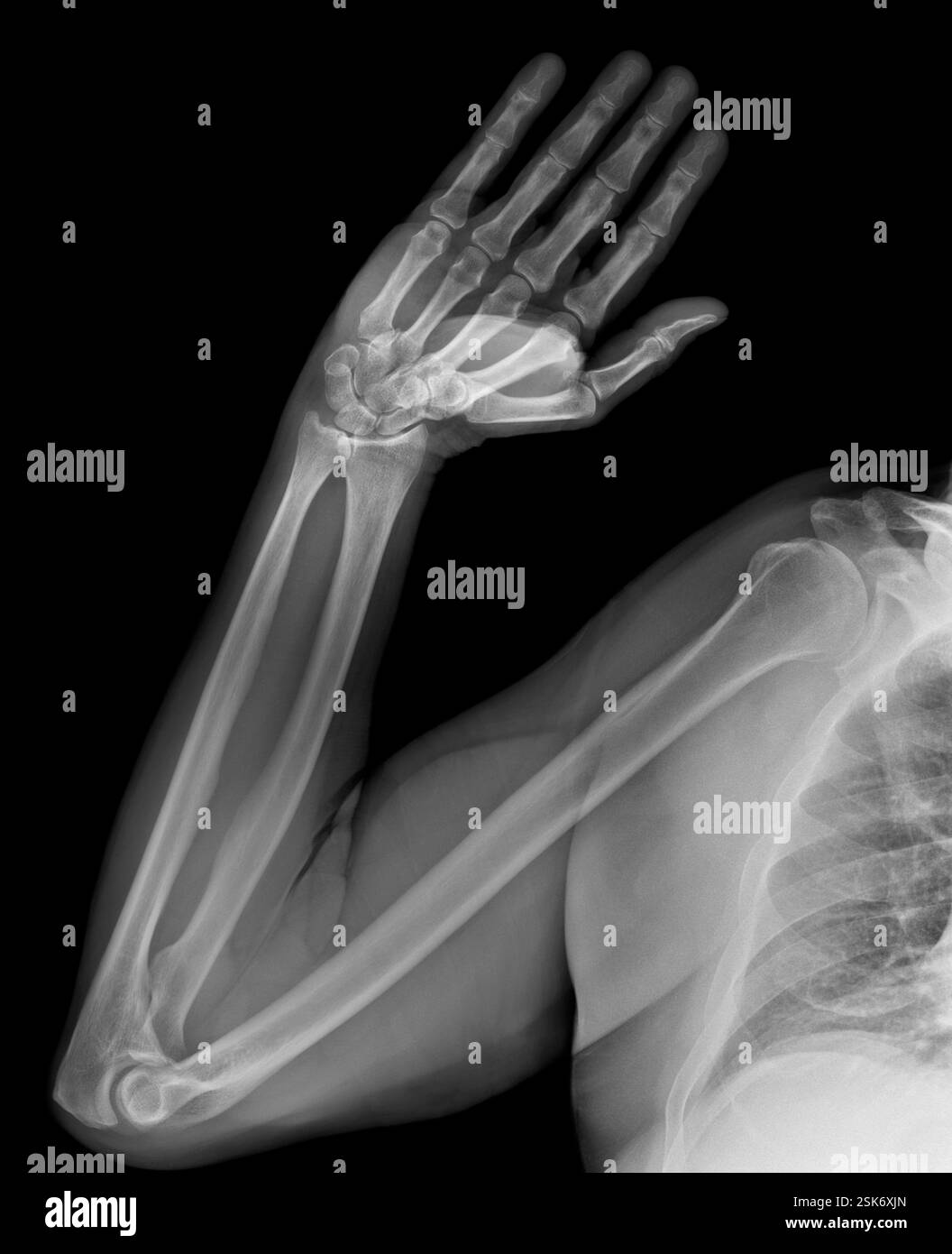 Healthy arm. Frontal X-ray of a healthy patient's right arm, showing ...