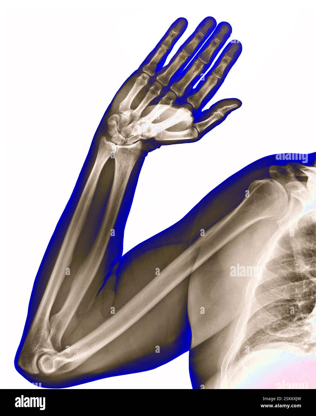 Healthy arm. Frontal coloured X-ray of a healthy patient's right arm ...