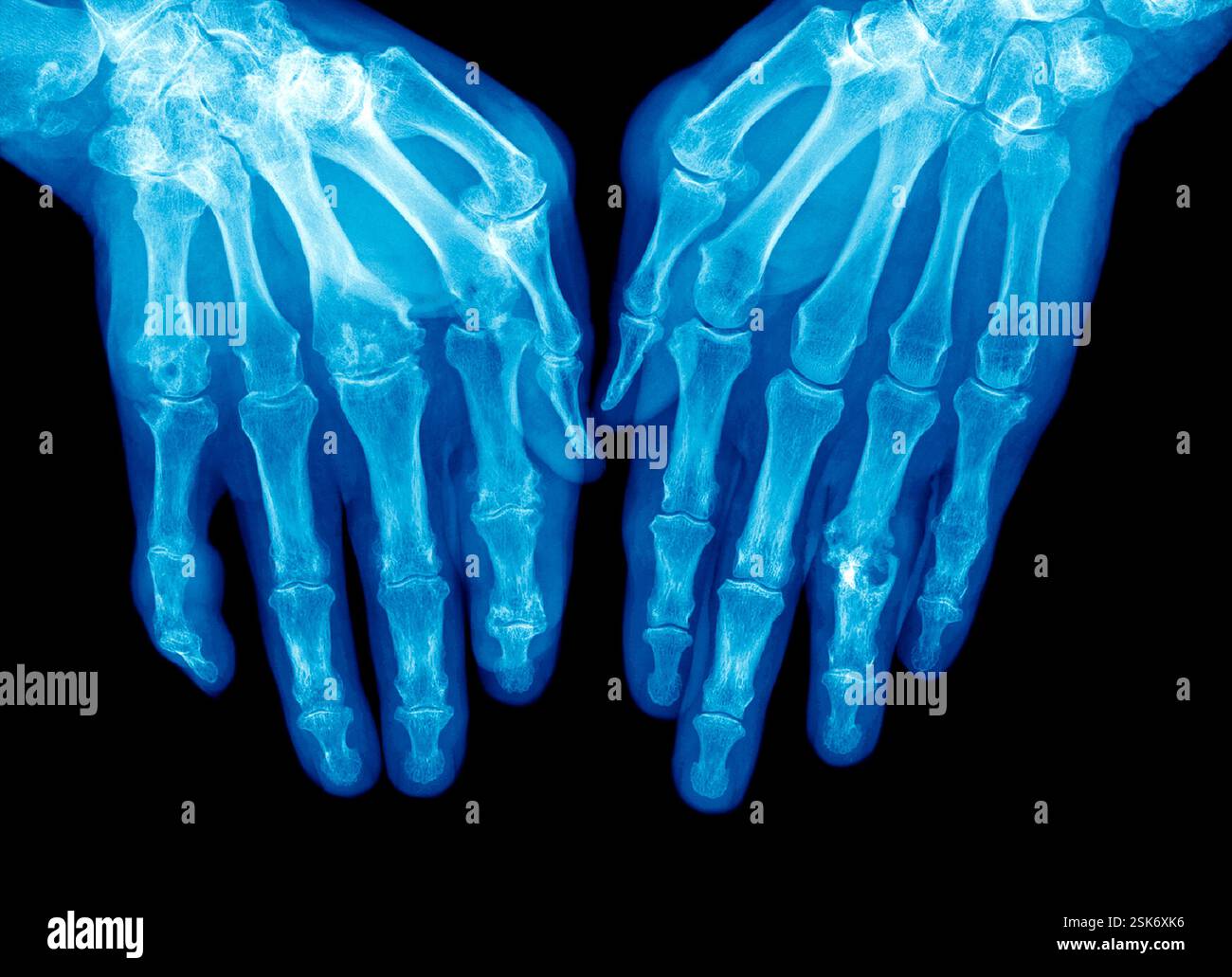 Gout. Coloured X-ray of the hands of a patient with gout in the joints ...